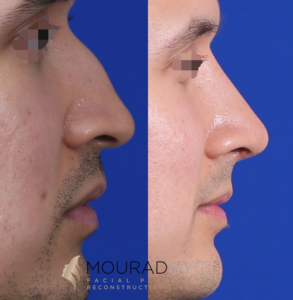 Expert Saddle Nose Correction NYC | Restore Confidence